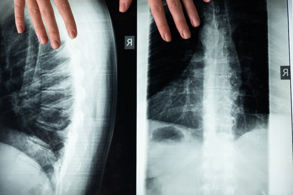 Spondiloza kralježnice [Šta je, simptomi, dijagnoza i liječenje]