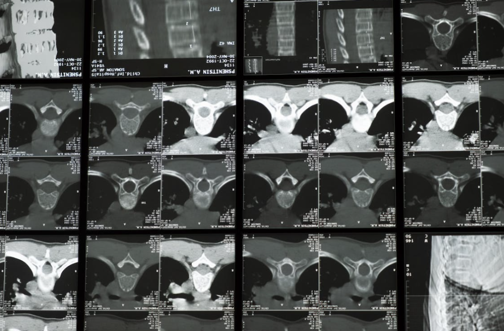 Spondiloza kralježnice [Šta je, simptomi, dijagnoza i liječenje]